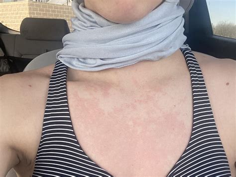 Red Chest Hives Anxiety Ranxietyhelp