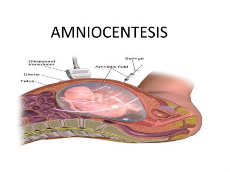 Amniocentesis Pptx