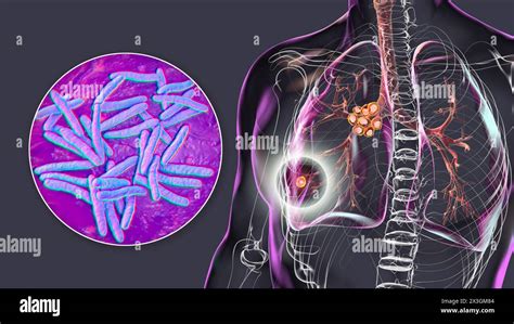 Illustration Of Primary Lung Tuberculosis With The Ranke Complex