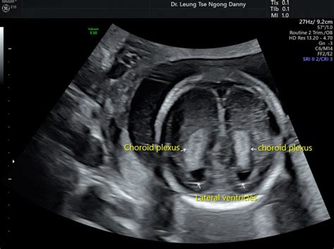 Routine Fetal Morphology Scan Hkog Info Routine Fetal Morphology Scan Hkog Info