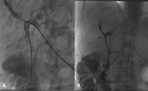 A Percutaneous Transhepatic Cholangiogram Guided External Biliary