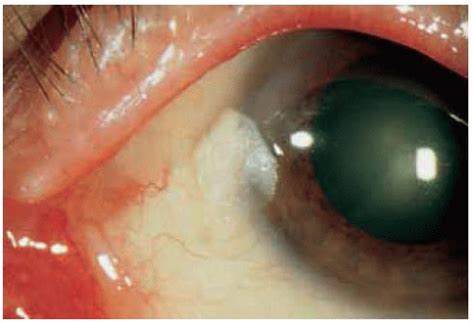 Conjunctival Intraepithelial Neoplasia Conjunctival And Corneal