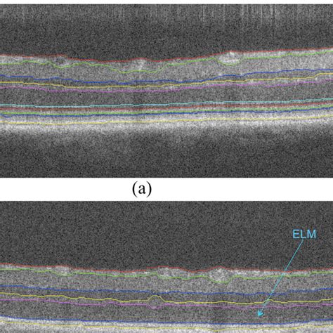 PDF Automatic Segmentation Of Up To Ten Layer Boundaries In SD OCT Images Of The Mouse Retina
