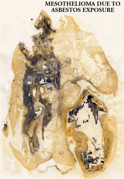 Asbestos Disease Qbm Compliance Reporting Specialists