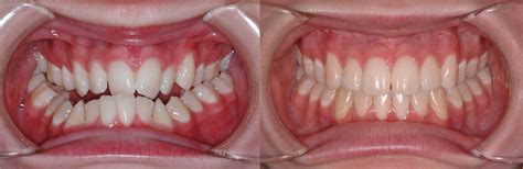 Smile Gallery Fargo Orthodontics Orthodontics Fargo
