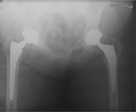 The Direct Anterior Approach To Revision Total Hip Arthroplasty Musculoskeletal Key
