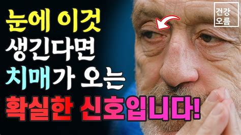 눈에 이것 생긴다면 치매가 오는 신호입니다 지금 당장 확인해 보세요 Youtube