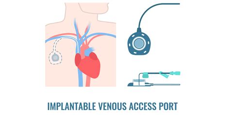 Port Placement Surgery Warrioragainstbreastcancer