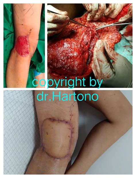 Dr Hartono S On Linkedin After Malignant Sarcoma Resection At Right Knee The Oncologist Had A…