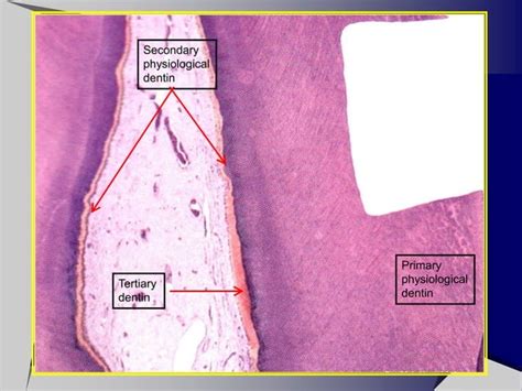 Dentinal Hypersensitivity Pdf
