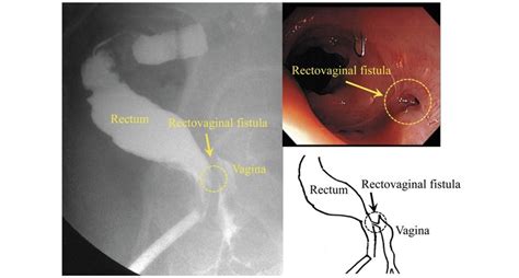 Sintomas E Diagnósticos Da Fístula Retovaginal