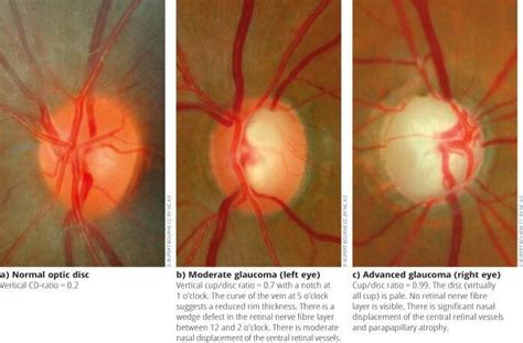 Rao Musaddaq Ali On Linkedin The Optic Nerve Head In Glaucoma ️ Characteristics Of A Glaucomatous