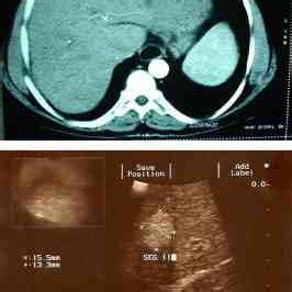 Two Hepatic Focal Lesions Shown In The Left Lobe By The CT In Different Download Scientific
