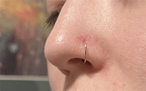 Scar Hyperpigmentation Around Nose Piercing After Irritation Bump R Scar Hyperpigmentation Around Nose Piercing After Irritation Bump R