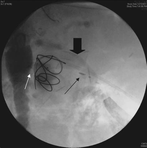 A Hybrid Repair Of A Superior Mesenteric Artery Pseudoaneurysm Using