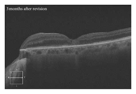 Preoperative And Postoperative OCT Scans A Preoperative OCT Scan Of Download Scientific