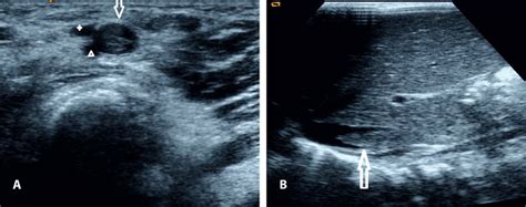 Ultrasound Image Showing A Echogenic Thrombus Arrow In The