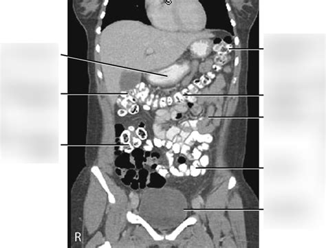 Coronal Abdominal Ct Diagram Quizlet