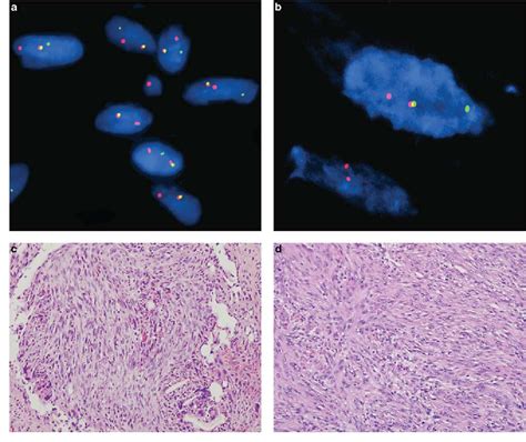 Nodular Fasciitis Semantic Scholar