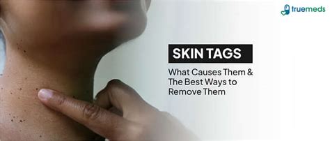 Clobenate Gm Cream Uses Side Effects Price And Substitutes