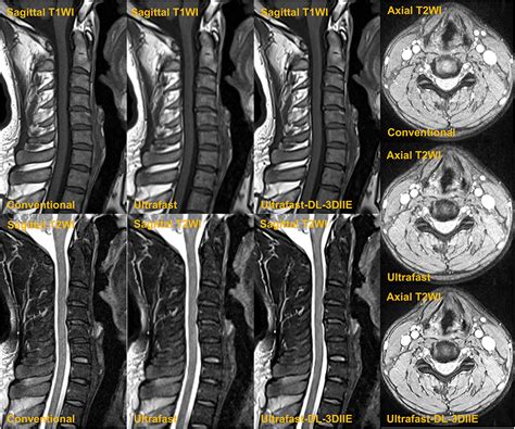 ultrafast cervical spine mri by 3d iterative image system jmdh