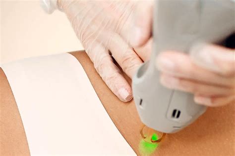 مراقبت های لازم بعد از لیزر بیکینی نکات مهم و ممنوعیت ها