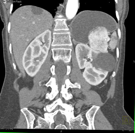 Gastric Gist Tumor Stomach Case Studies Ctisus Ct Scanning