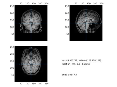 Solving The Eeg Forward Problem Using Bem And Fem Fieldtrip Toolbox