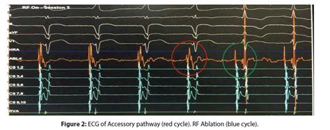 Accuracy Of The New Electrocardiogram Algorithm In Predicting Loc