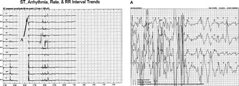 This Figure Illustrates Two Issues That Can Occur During Holter