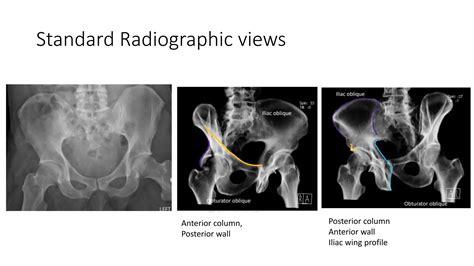 Acetabulum Fractures Anatomy Radiological Evaluation Classification And Management Pptx