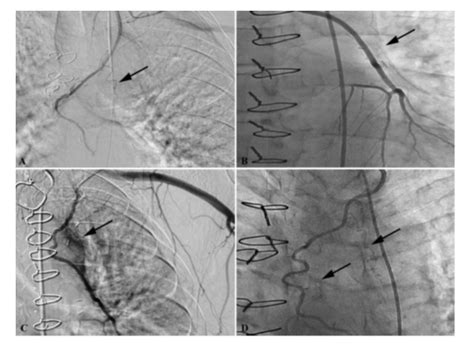 Surgical Technique Of Angiogenesis Stimulation Extracardial Myocardial Revascularization In
