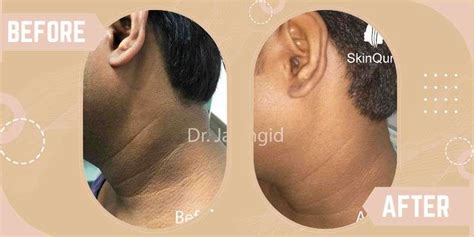 Neck Pigmentation Treatments In Delhi Skinqure