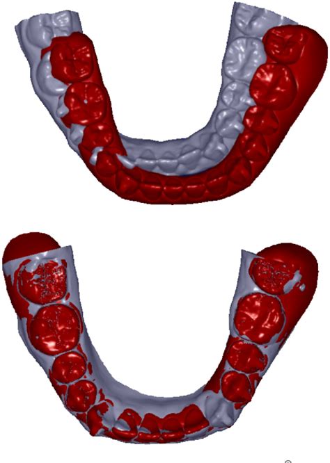 Figure 1 From Treatment Efficiency Of Maxillary And Mandibular Orovestibular Tooth Expansion And