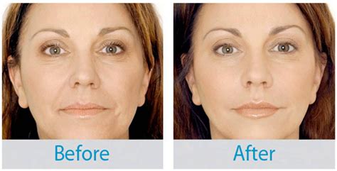 PDO Threads Aesthetic Skin Treatments In Ipswich Jinc Beauty