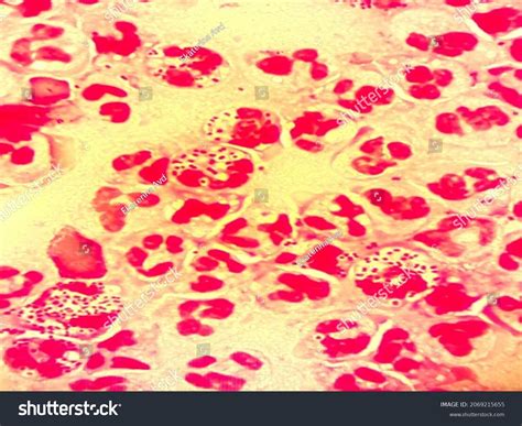 Gram Negative Diplococci Gonorrhea