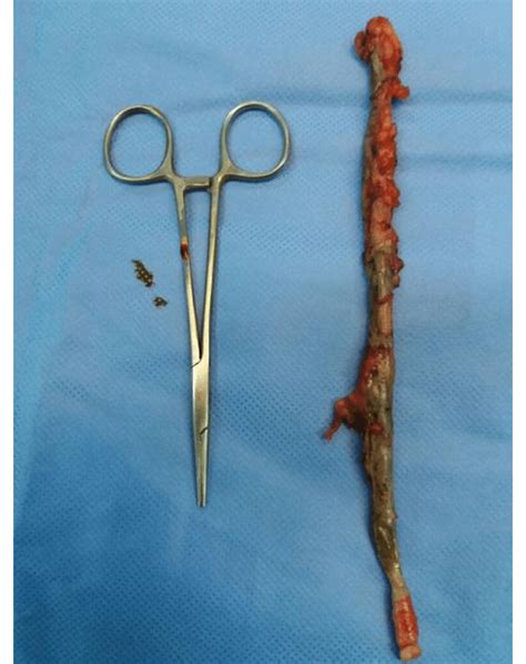 The Long Appendix After Dissection Download Scientific Diagram