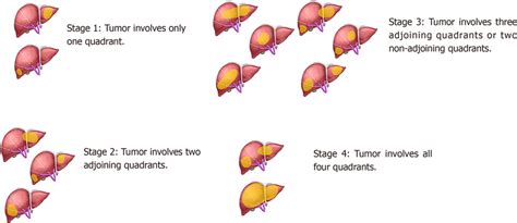 Definition Of The Pretreatment Extent Of Disease Or Pretext