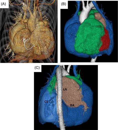 A Preoperative Three‐dimensional Computed Tomography Scan B In The Download Scientific