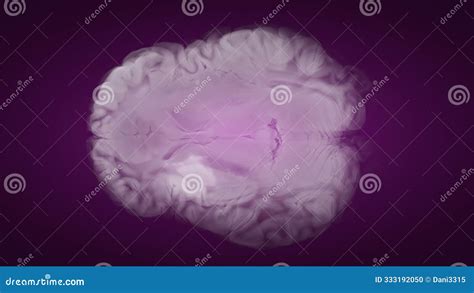 Brain Mri Revealing Chronic Ischemic Stroke And Cerebral Infarction