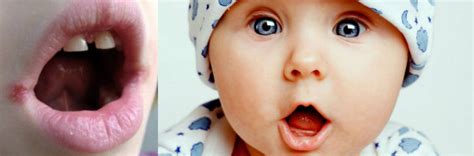 ¿como Curar Las Boqueras Adios Queilitis Angular Como Curar La Queilitis Angular Cremas