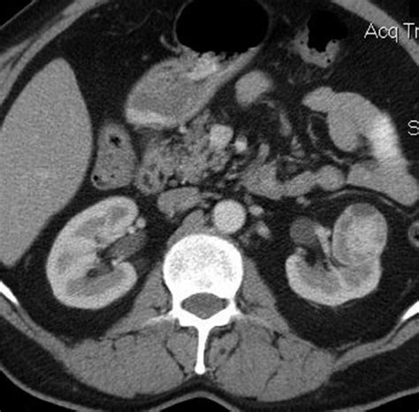 Port Placement For Robotic Prostatectomy Download Scientific Diagram