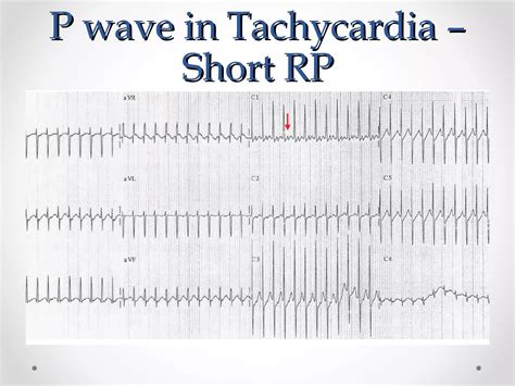Svt In Pediatrics Ppt