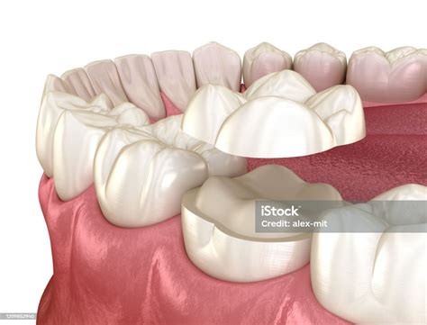 어금니 치아 위에 온레이 세라믹 크라운 고정 인간의 치아 치료의 의학적으로 정확한 3d 그림 3차원 형태에 대한 스톡 사진 및 기타 이미지 Istock