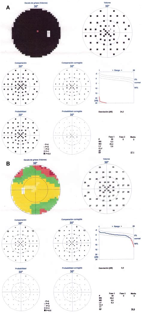 Neurological Visual Field Defect