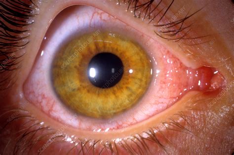 Bacterial Conjunctivitis