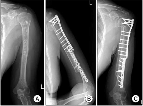 A 55 Year Old Male Patient With Chondrosarcoma At The Left Humerus A Download Scientific