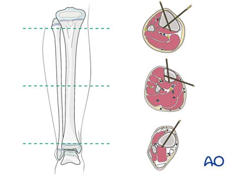 External Fixation For Greenstick Fracture Of The Tibia