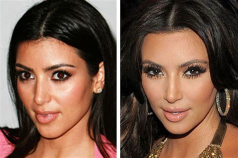 Shilakejawani420 Kim Kardashian Before And After Surgery