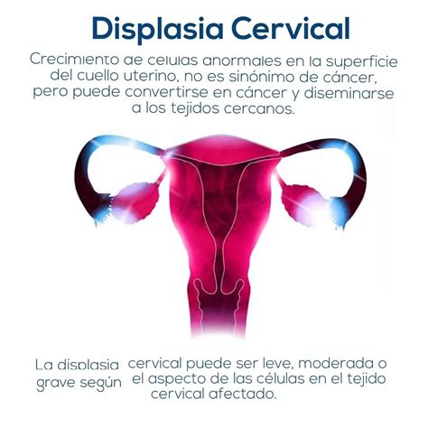 ¿qué Es La Displasia Cervical Ginecologos En Queretaro